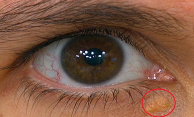 Descubra seus níveis de colesterol apenas pelos seus olhos - extra curiosos