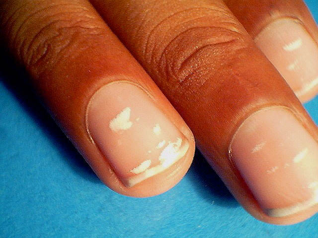 O que são essas manchas brancas nas unhas? – Fatos Desconhecidos
