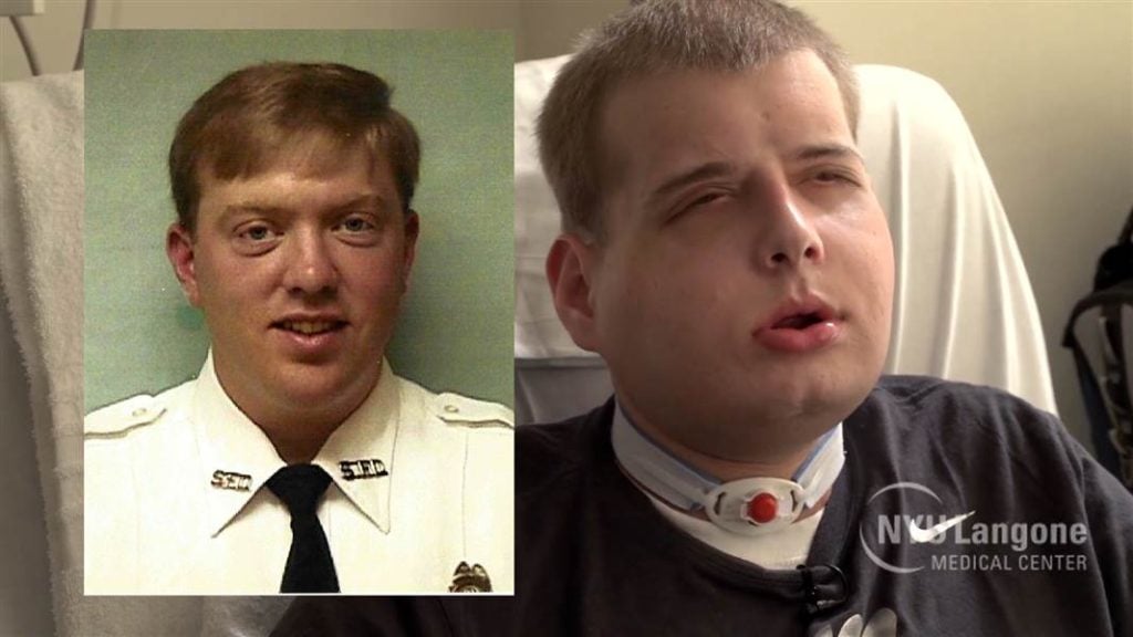 Saiba como ficou a aparência do primeiro transplante de rosto do mundo