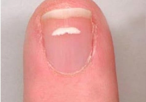 Você sabe por que aparecem aquelas manchinhas brancas nas unhas ...