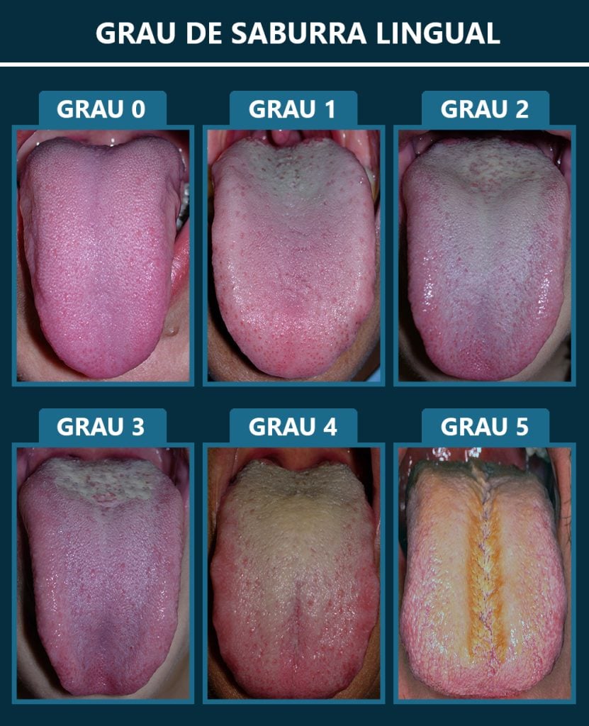 Por que algumas pessoas tem a língua branca?