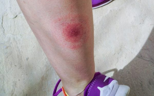 8 tipos diferentes de picadas e como identificá-las – Fatos Desconhecidos