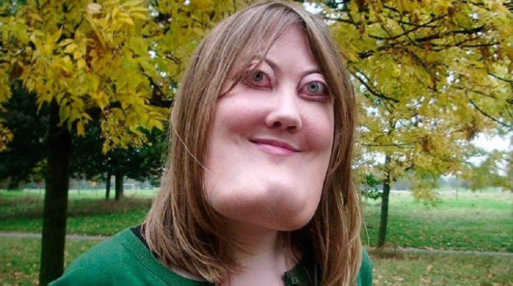 Conheça a história de Victoria Wright, portadora da rara 'Doença do ...