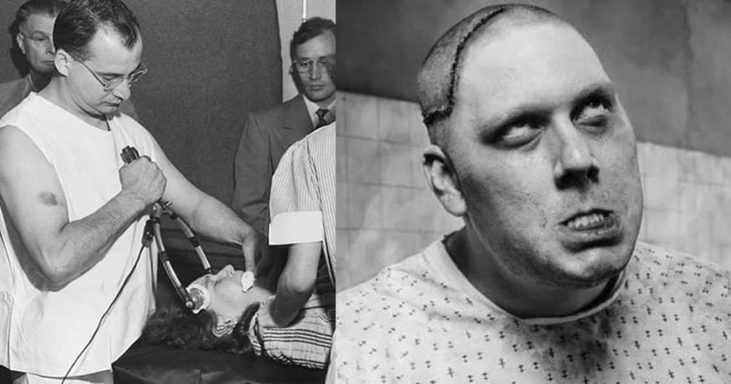 10 fatos chocantes sobre a lobotomia – Fatos Desconhecidos