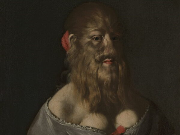 7 histórias surpreendentes de pessoas com síndrome de lobisomem – Fatos ...