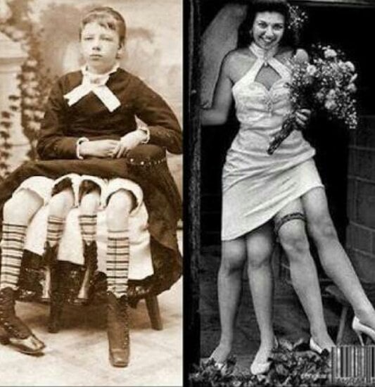 Conheça Myrtle Corbin, a mulher que tinha 4 pernas