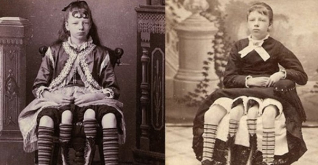 Conheça Myrtle Corbin, a mulher que tinha 4 pernas